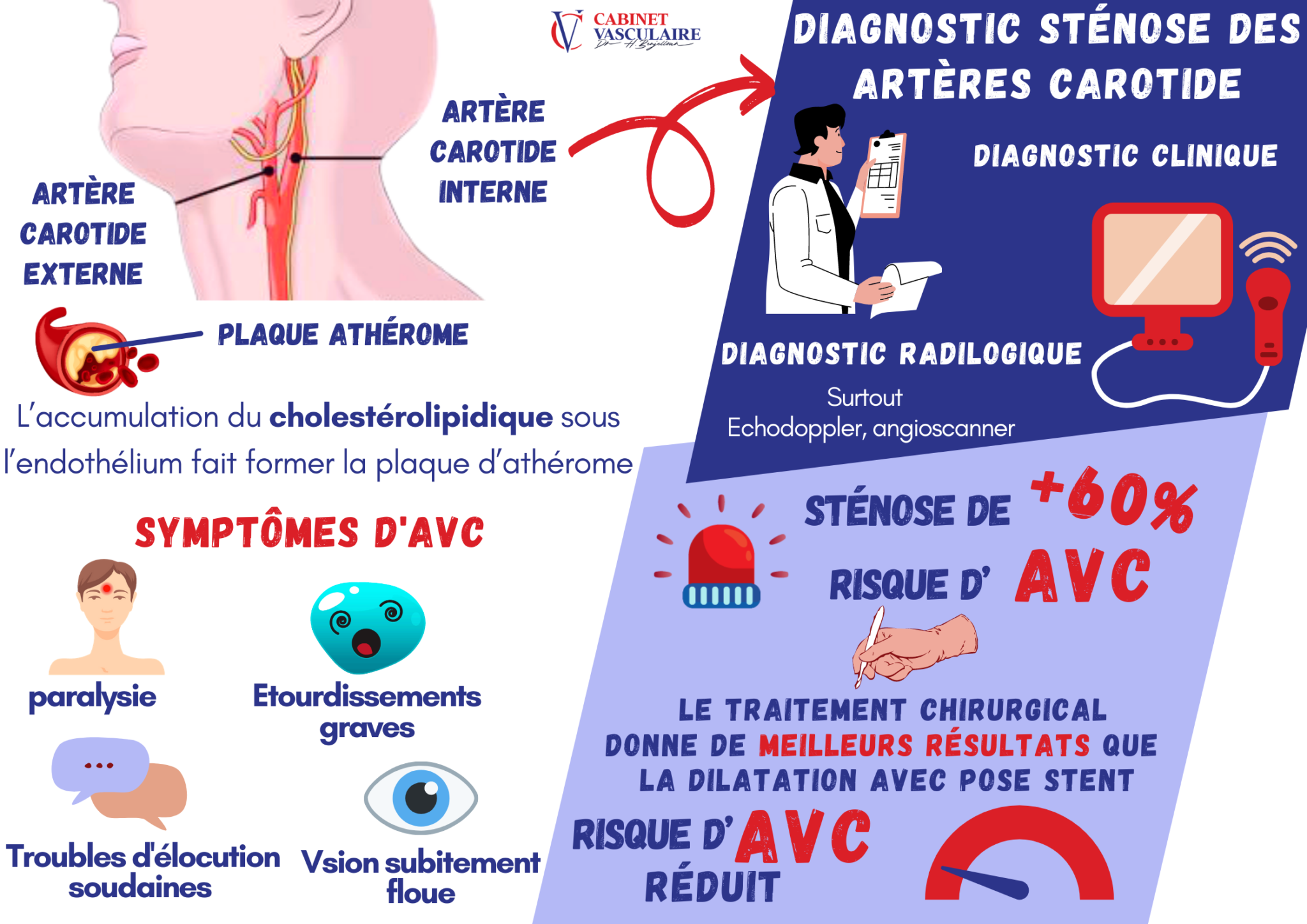 Carotid Artery Disease - Varicose Veins and Vascular Center